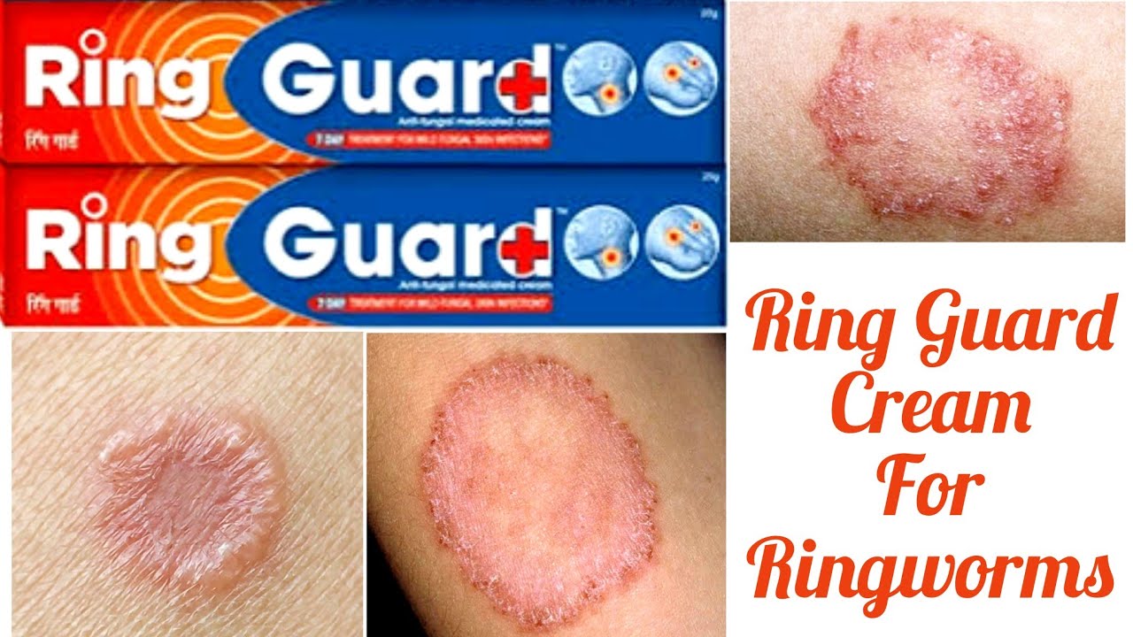 Ring Guard Cream for Ringworms - YouTube