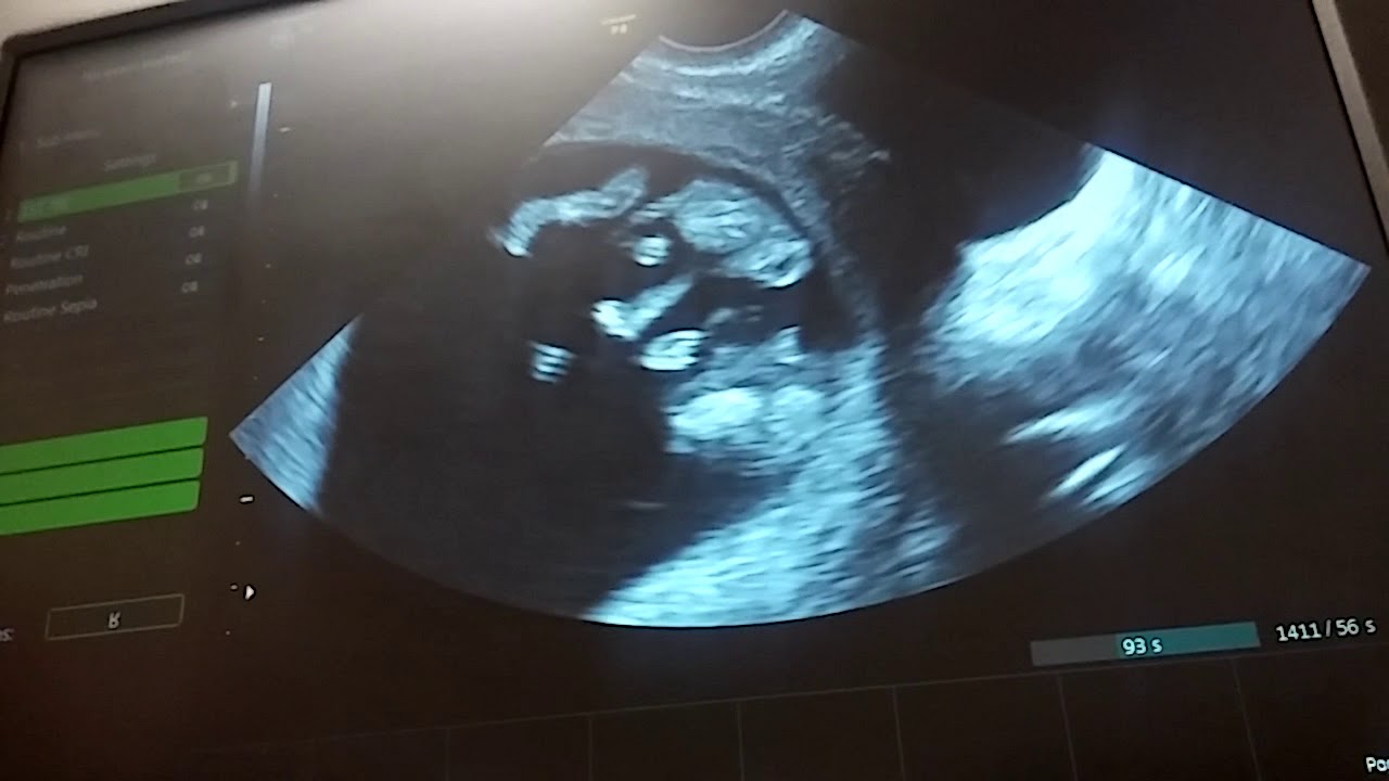 11 weeks and 5 days ultrasound - YouTube