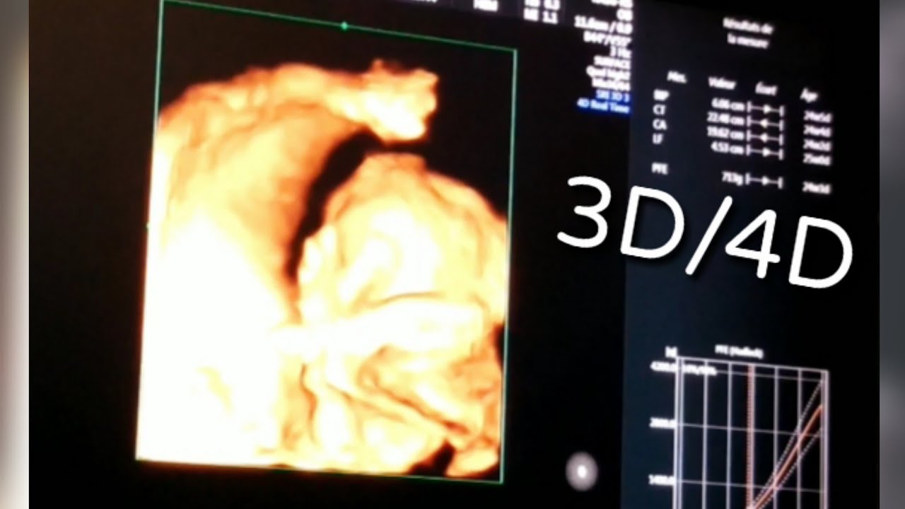 échographie morphologique (3D/4D) 6mois de grossesse /تصوير ايكو كامل😍 ...