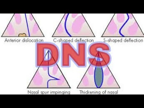 Deviated nasal septum / DNS lecture ENT videos S.p medical college ...