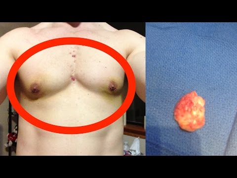 Common Gyno Myths - Removing the whole gland?