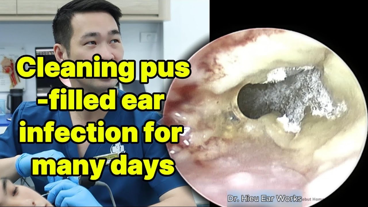 Cleaning pus filled ear infection for many days | ear cleaning | ASMR ...