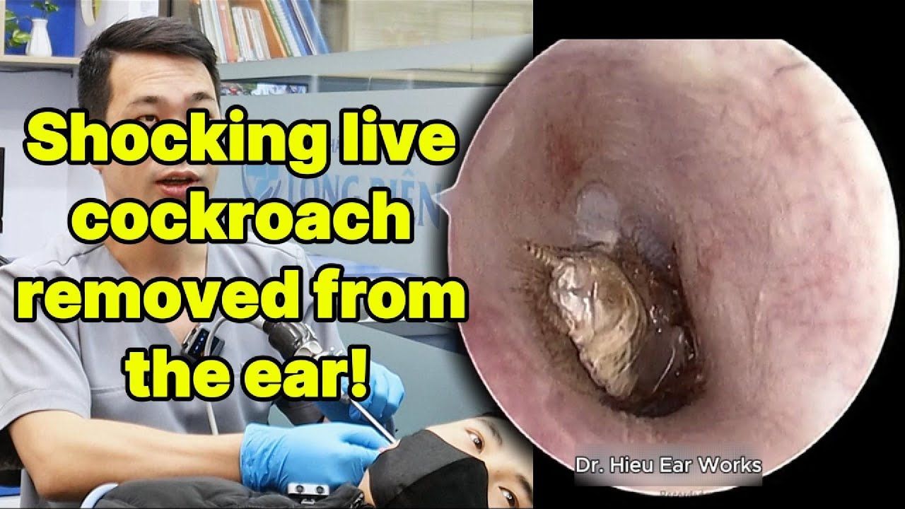 Shocking live cockroach removed from the ear! | ear cleaning | ASMR ...