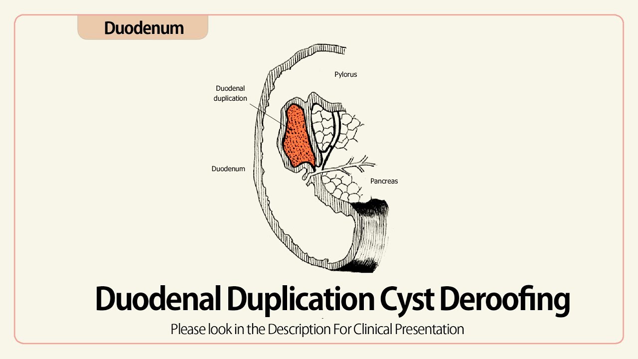 Linear EUS: Duodenal Duplication Cyst Deroofing - YouTube