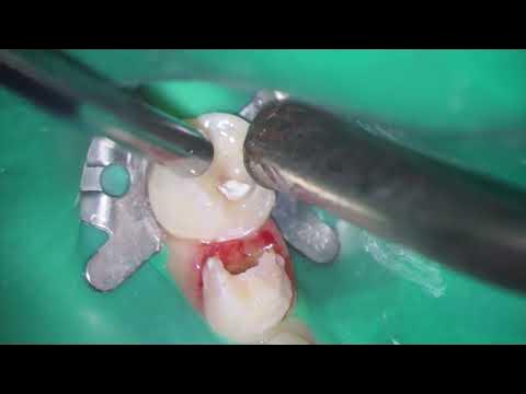 Direct pulp capping with Endocem MTA Premixed regular on primary 2nd ...