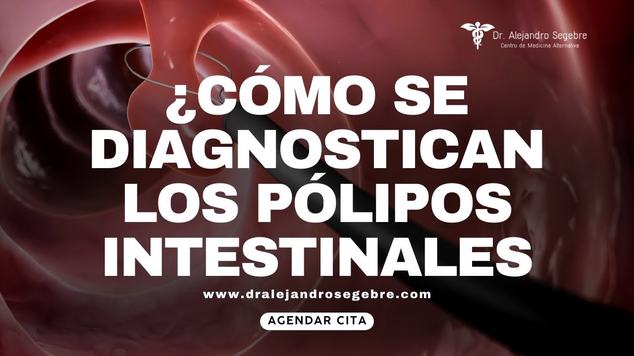 ¿CÓMO SE DIAGNOSTICAN LOS POLIPOS INTESTINALES? DR ALEJANDRO SEGEBRE ...