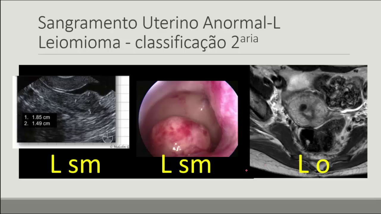 Papel dos métodos de imagem no sangramento uterino anormal - YouTube