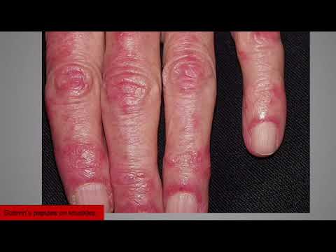 What is this rash and muscle pain - YouTube