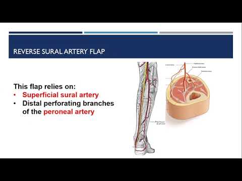 Reverse Sural Flap (Didactic) - Dr. Terry - YouTube