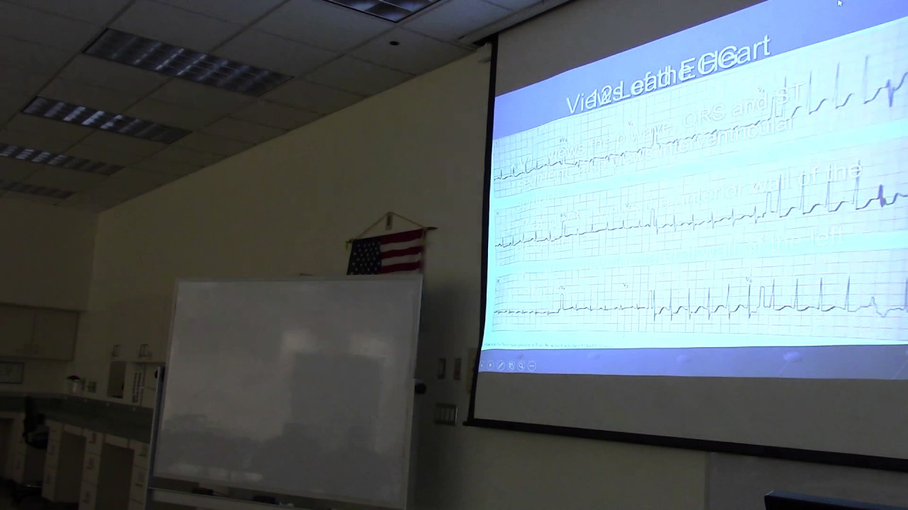 Heart Blocks & Pacemaker Rhythms Part 2 - YouTube