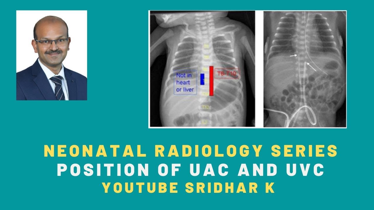 Neonatal Radiology L Position Of UAC And UVC nicu radiology YouTube