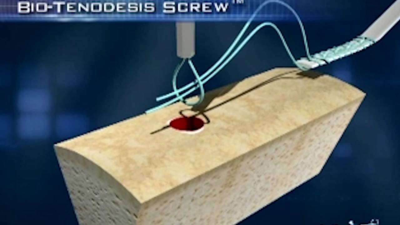 biceps tenodesis - Joshua Hornstein, M.D. - YouTube