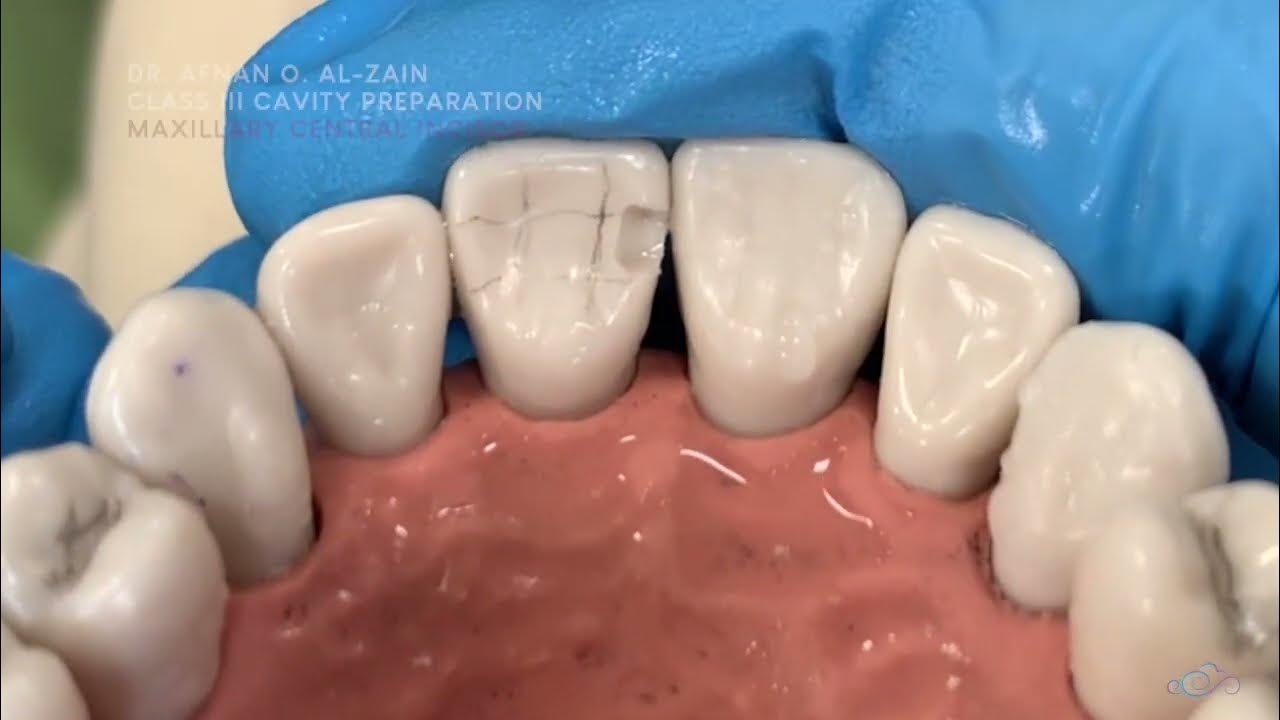 Class III Cavity Preparation Maxillary Central Incisor 11 Moderate class-iii-cavity-preparation-maxillary-central-incisor-11-moderate