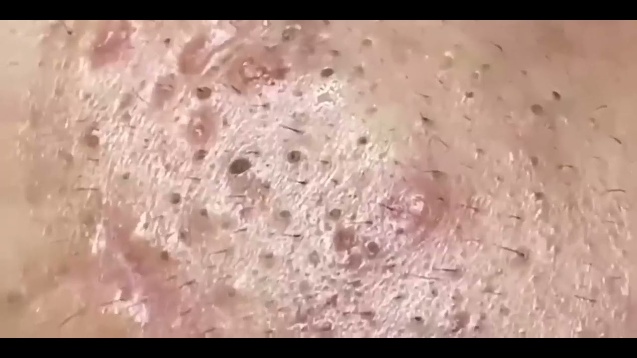 Blackhead Nose removal,Huge Nose acne blackheads extraction Pimple ...