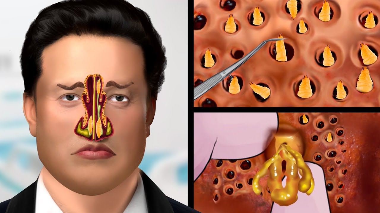 Asmr Clear Mucus Big Acne And Worm Infected Nose Acne Deep Cleaning Animation Youtube