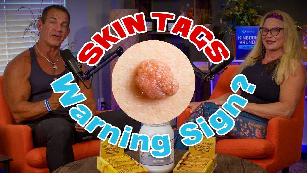 Skin Tags Are NOT Harmless — Here’s What They Really Mean! - YouTube