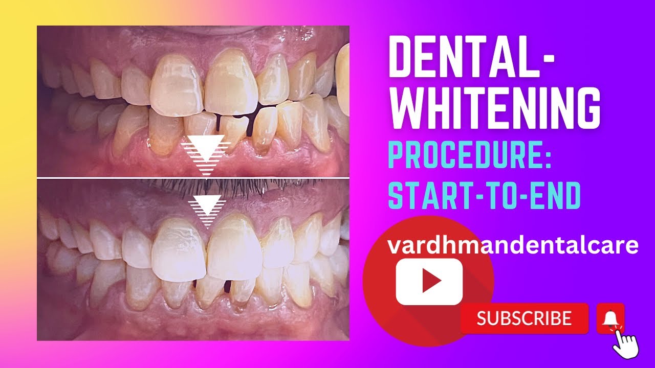 Dental-Whitening: A Single-Visit Procedure. Comfortable. Safe. Easy ...