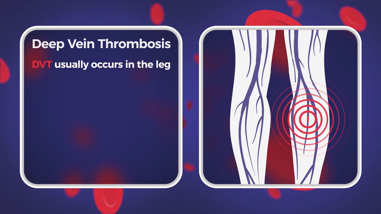 RBR Signs Of DVT - YouTube