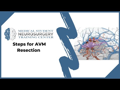 Steps for AVM Resection