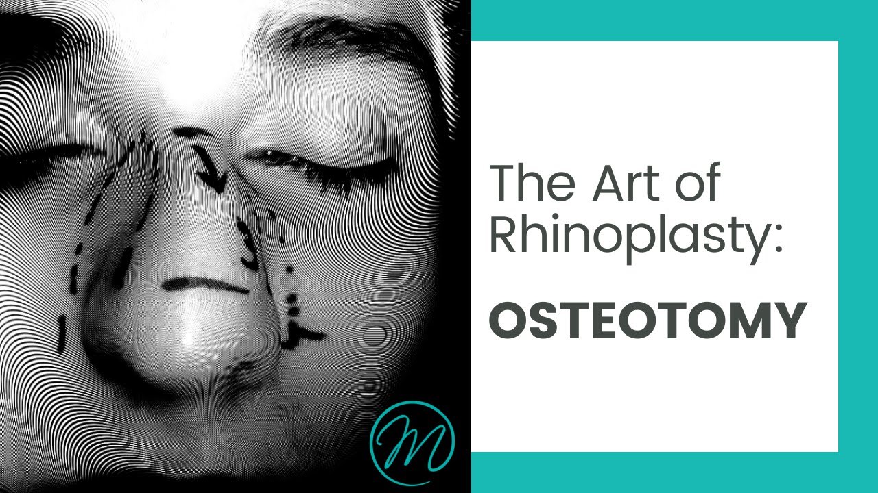 THE ART OF RHINOPLASTY: OSTEOTOMY - YouTube