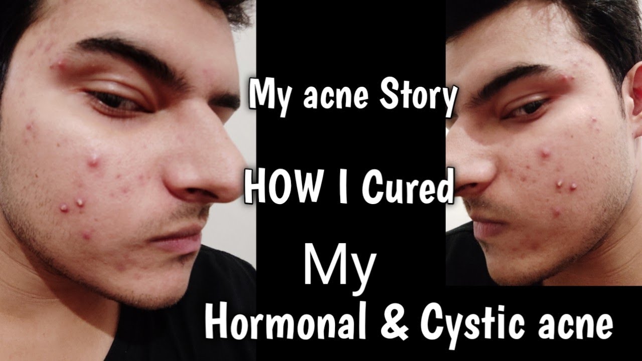 My acne story & Skincare journey | Saslic face wash | deriva bpo gel ...