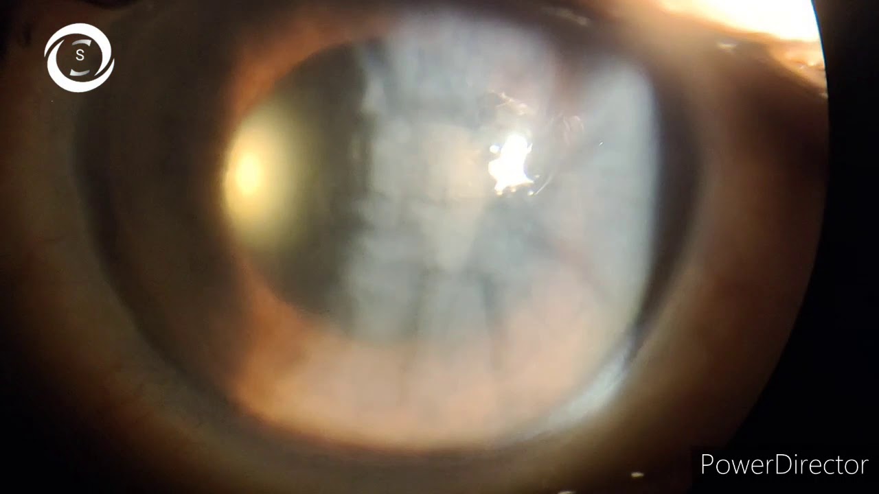 TASS toxic anterior segment syndrome - YouTube