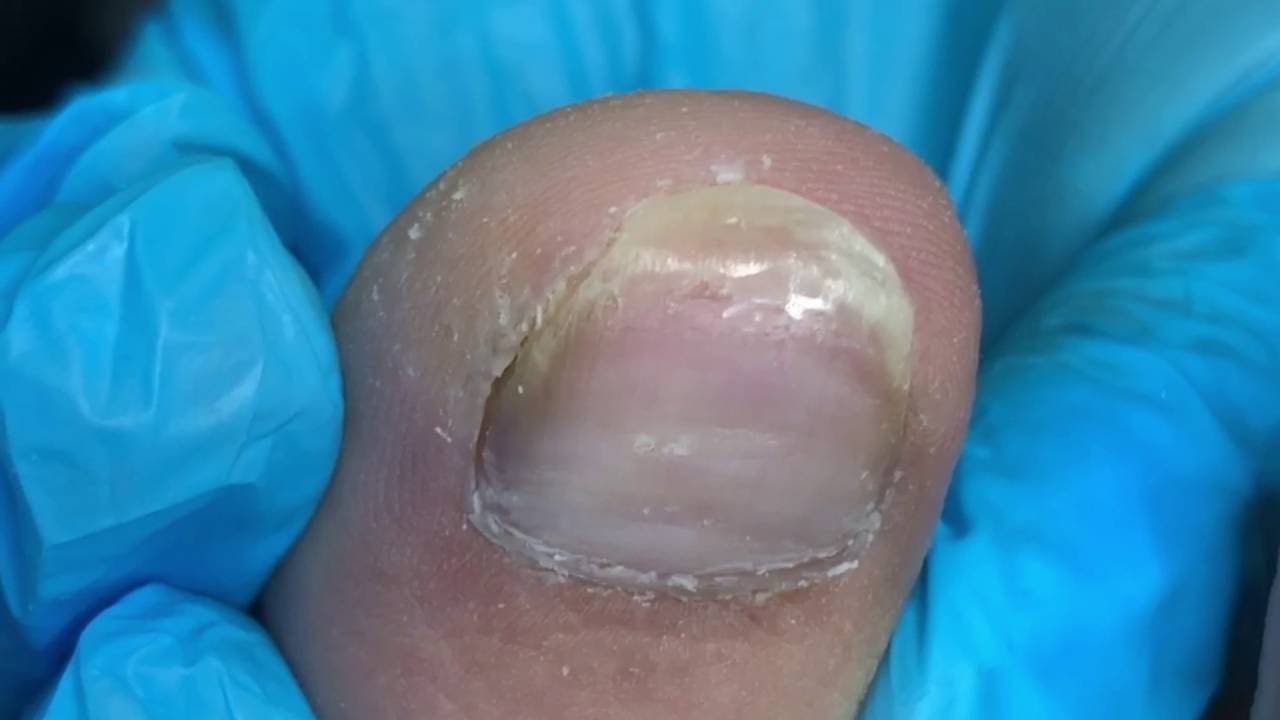 There is a nail hidden at the base of the toenail. Cut it off#nails # ...