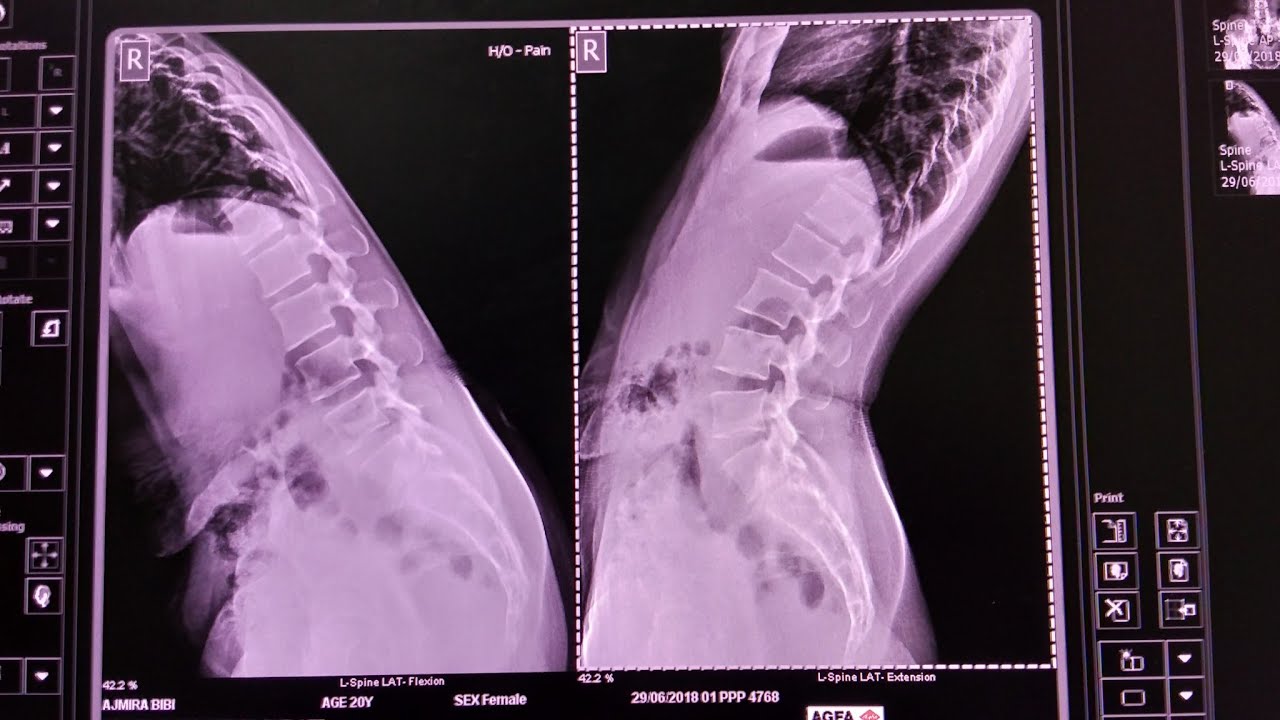 How to X-ray L.S.Spine Flexion & Extension views. Showing that position ...