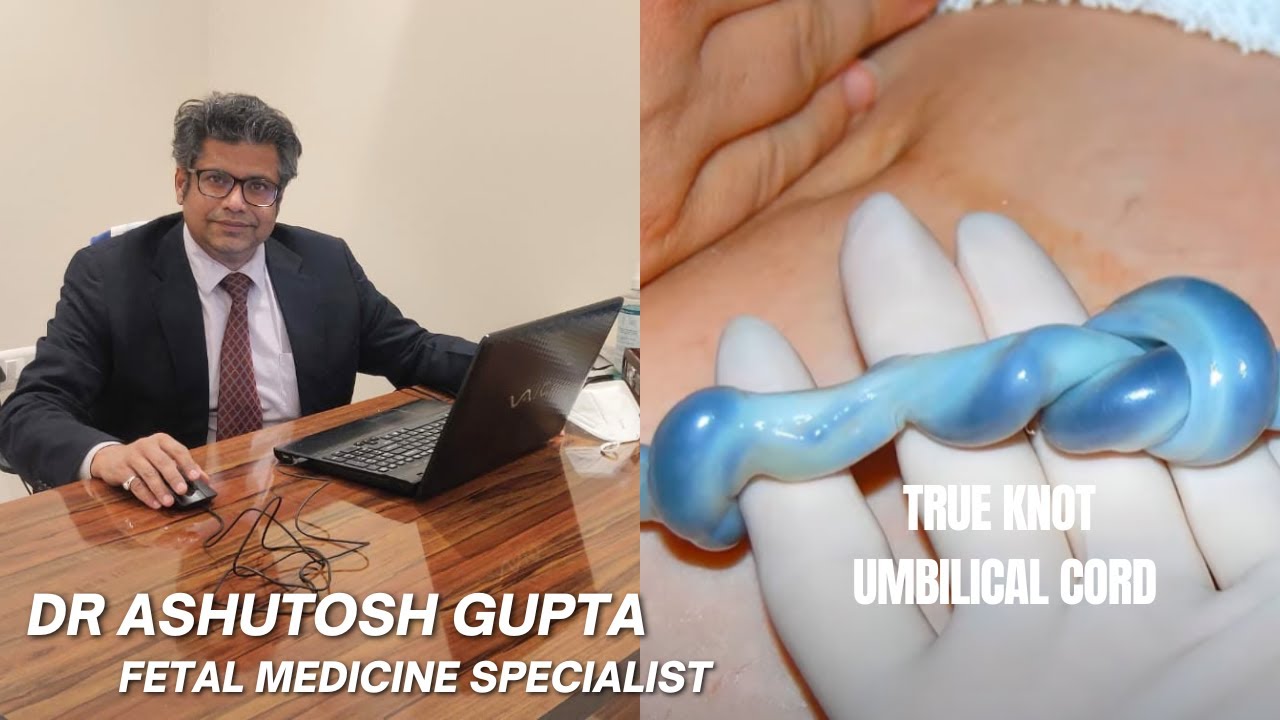 True Knot Umbilical Cord - YouTube