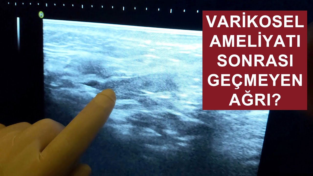 Varikosel Ameliyatı Sonrası Geçmeyen Ağrı Nedenleri: Nüks Varikosel ...