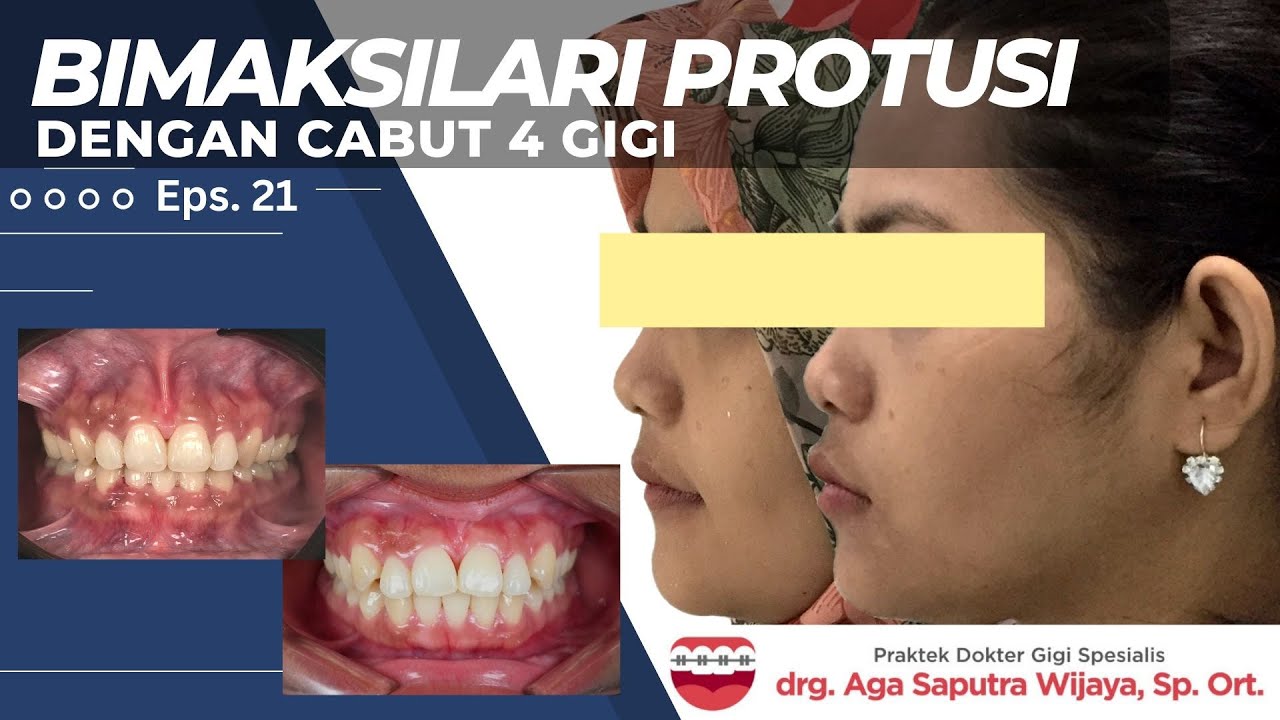 Bimaksilari Protusi Dengan Cabut 4 Gigi. Eps. 21 - YouTube