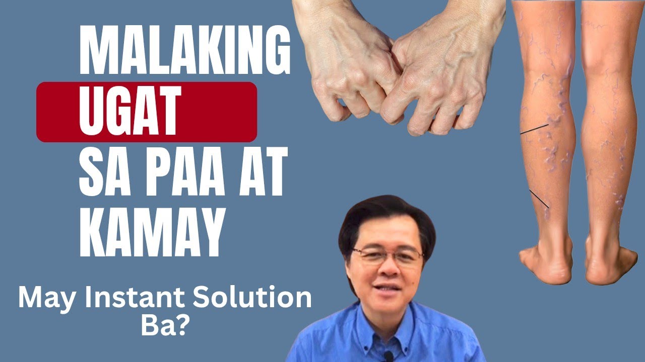 Malaking Ugat sa Paa at Kamay May Instant Solution Ba - YouTube