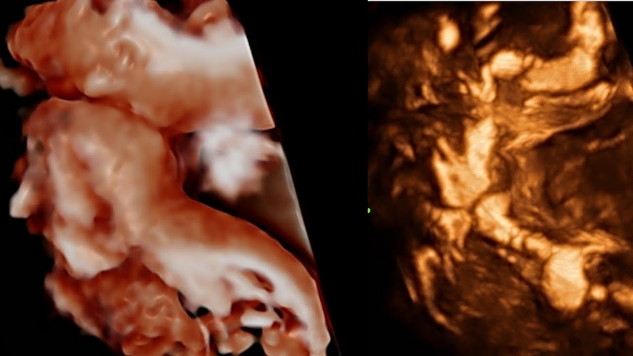 Rachischisis totalis & iniencephaly ultrasound vs segmental spinal ...