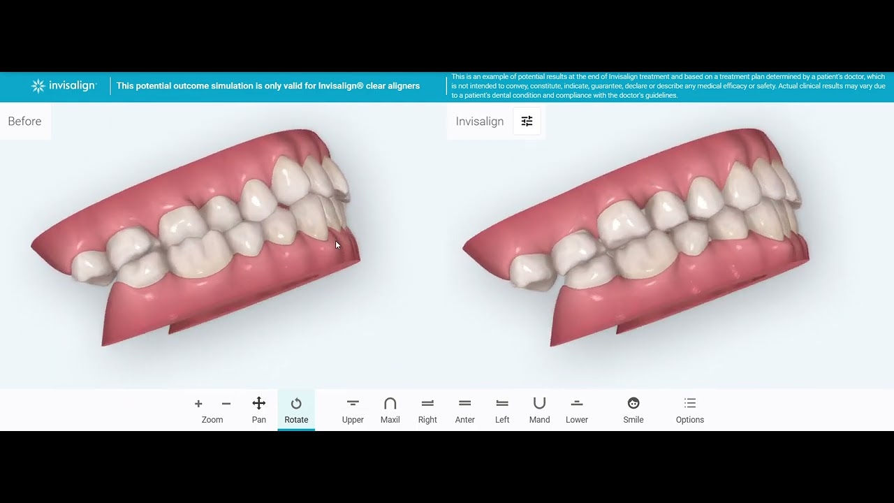 Invisalign outcome simulation - Alignment of teeth and cross bite ...
