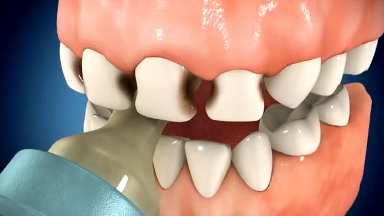 Baby Bottle Tooth Decay ,Nursing bottle caries, Dental caries in milk ...