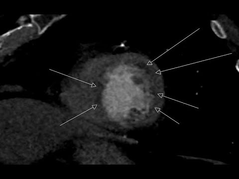 Myocardial Infarction in CT scan. - YouTube
