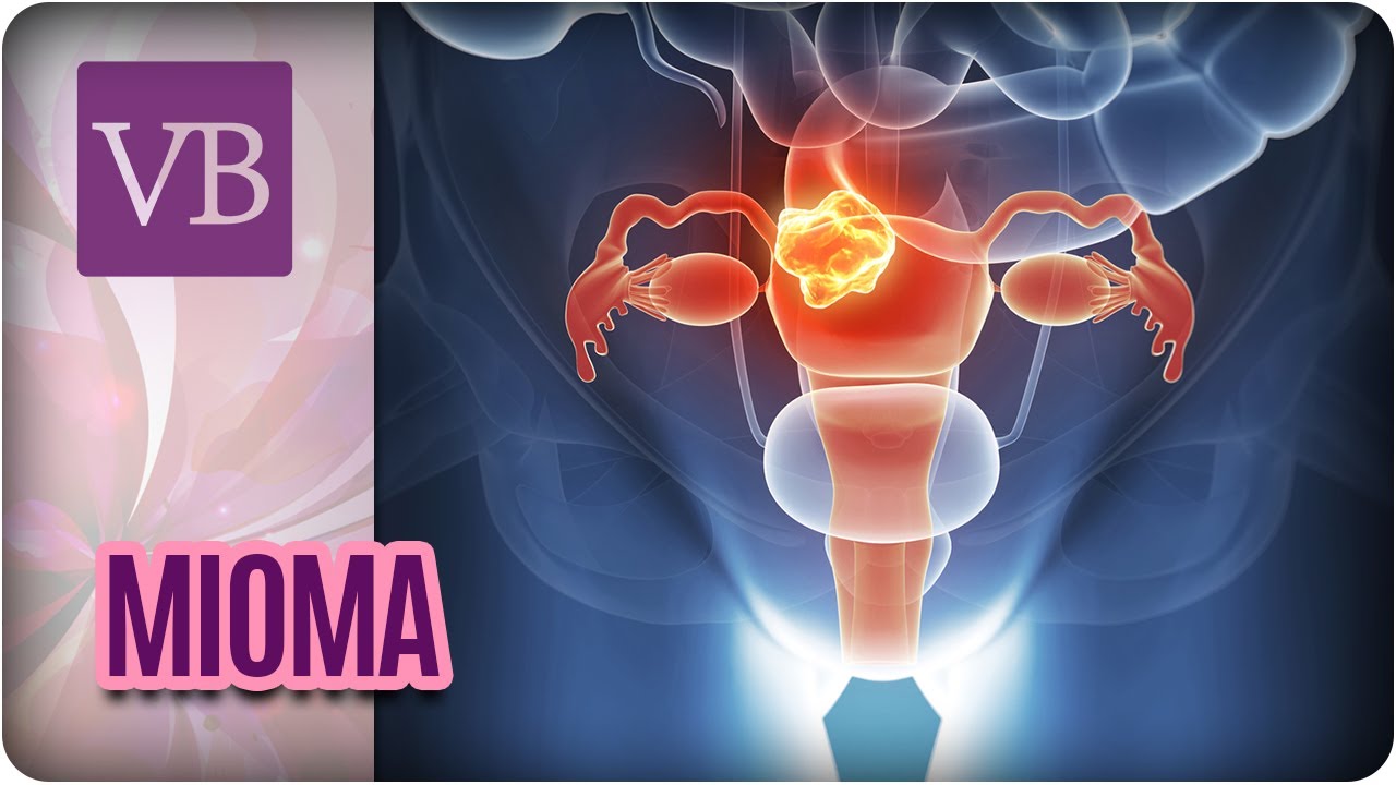 Mioma - Você Bonita (22/06/17) - YouTube