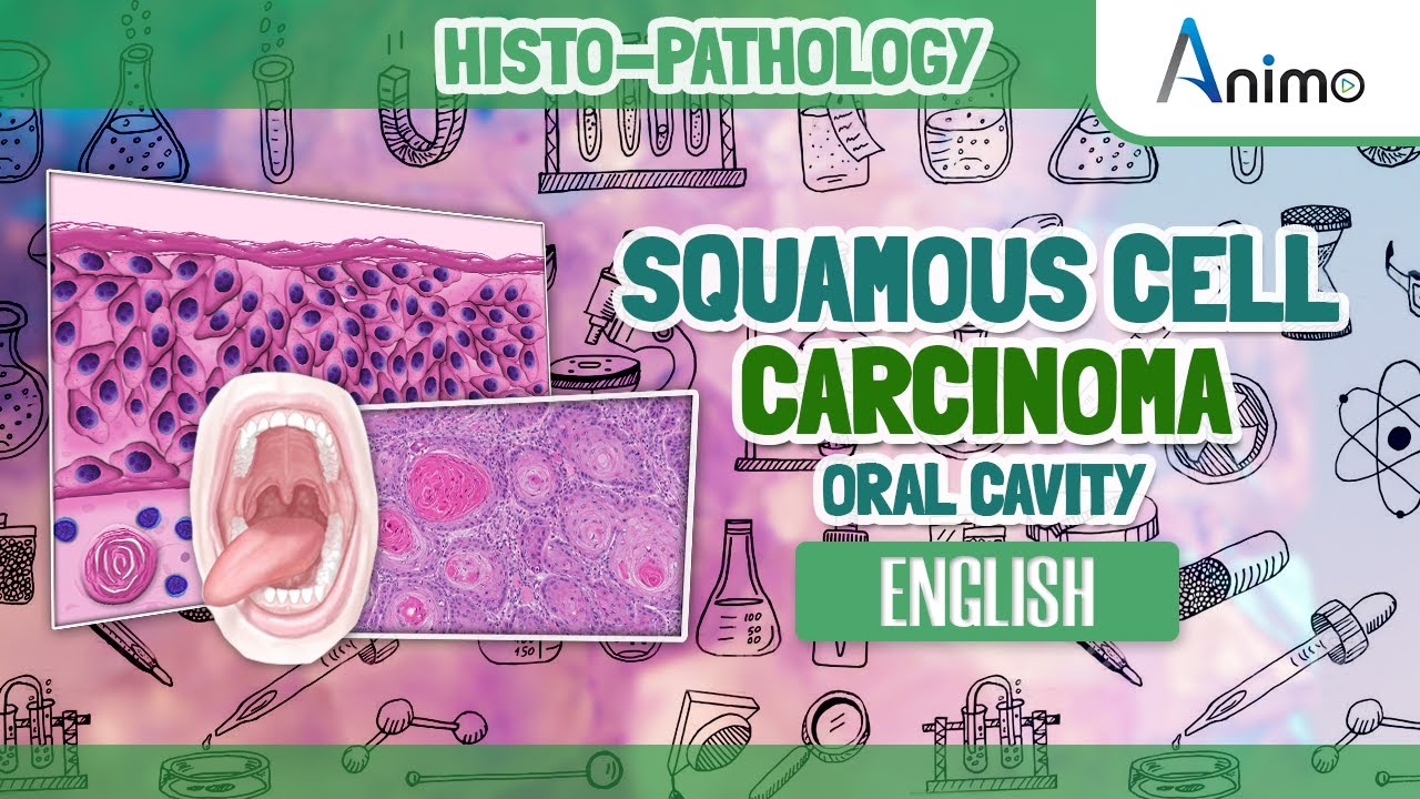 Squamous cell carcinoma of oral cavity | GIT Morphology | English - YouTube