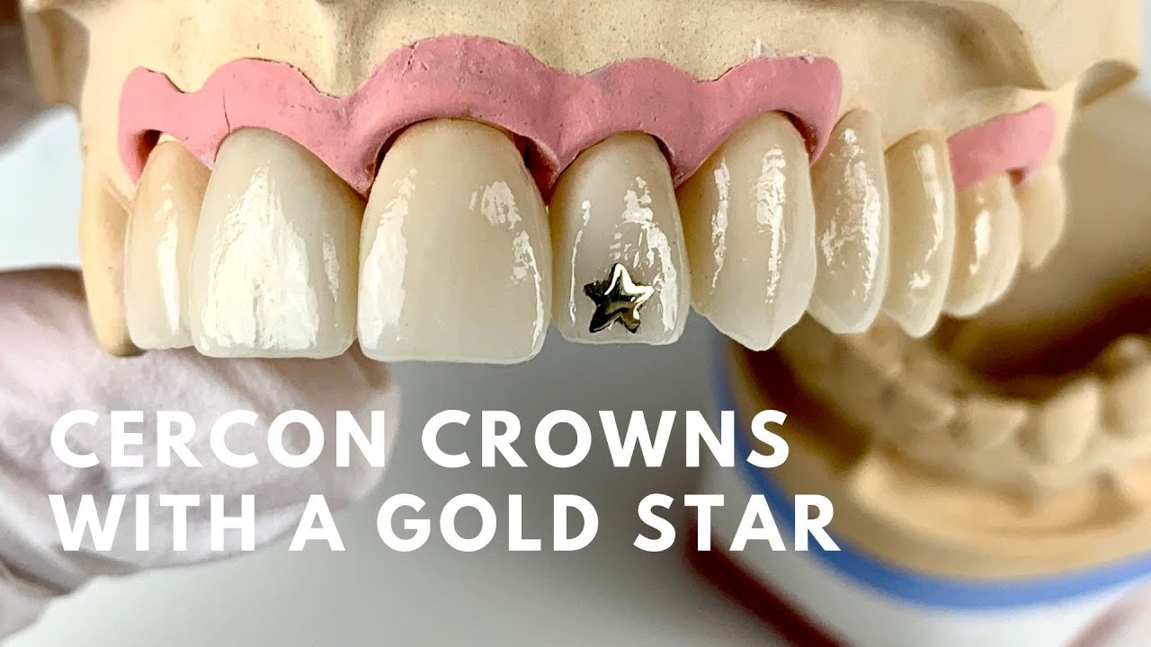 Cercon Crowns With A Gold Star - YouTube