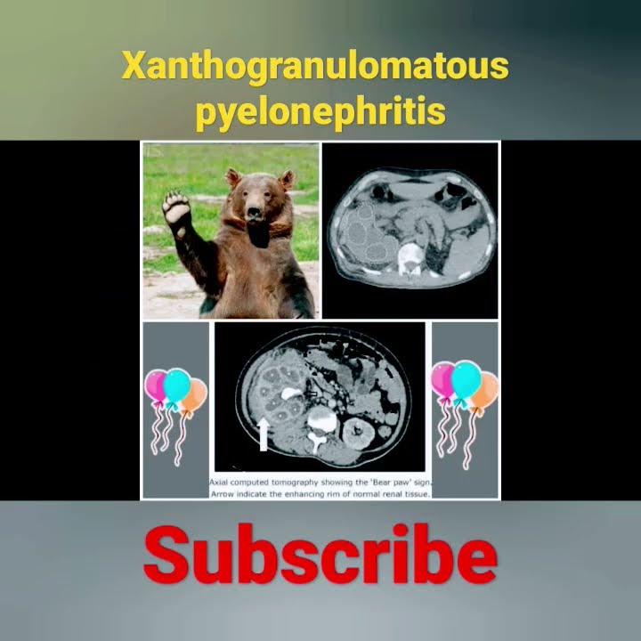 Bear paw sign - Xanthogranulomatous pyelonephritis - Radiology - YouTube
