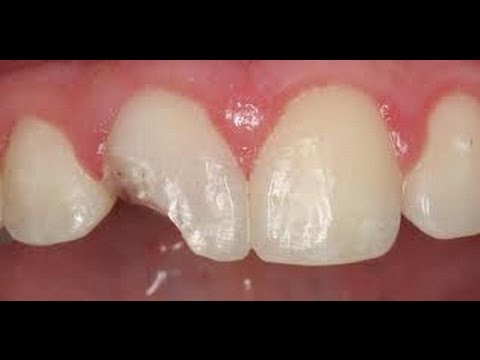 Letört egy darab a fogamból - YouTube