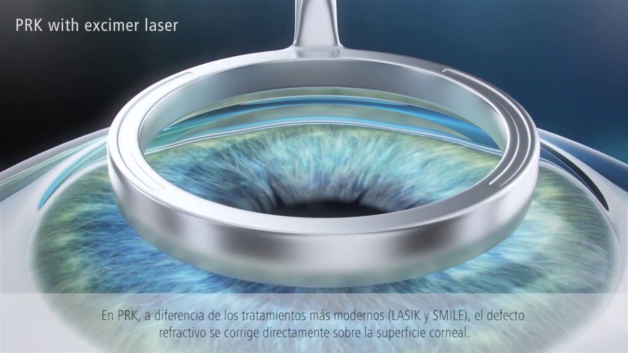 PRK Refractive Surgery | Cirugía Refractiva - IOA Madrid - YouTube