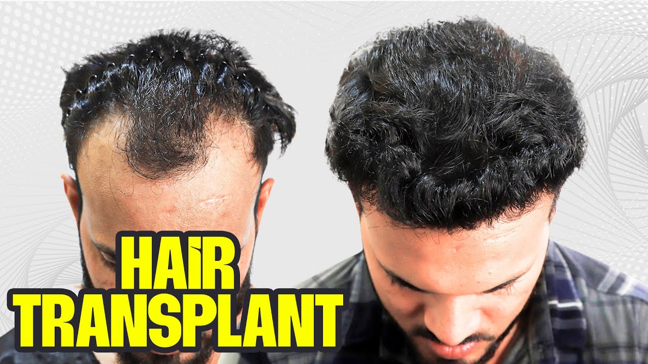 From Balding to Blooming: 1-Year Hair Transplant Result in Vashi 😍 ...