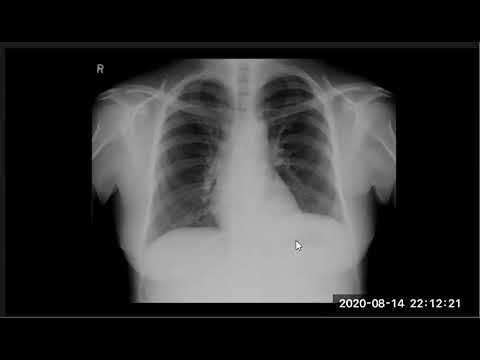 Subpulmonic Effusion - YouTube