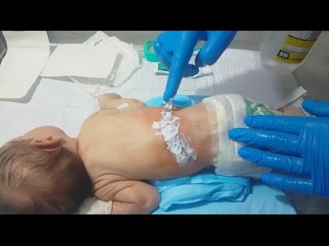 💉🌡Post Operative Care and Sterile Dressing for MMC Baby | Step by Step ...
