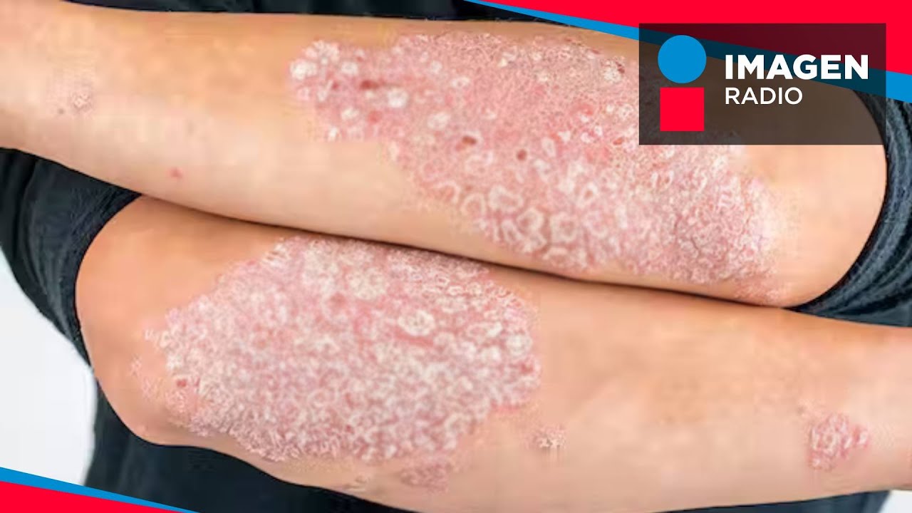 ¿Qué es y qué causa la Psoriasis? - YouTube