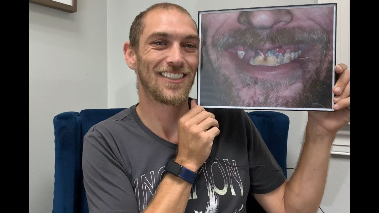 Tyler's Smile Makeover with Full Mouth All on Four Dental Implants in ...