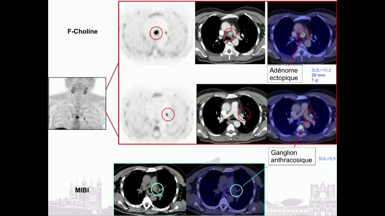Performance de la TEP/CT 18F-Fluorocholine - YouTube