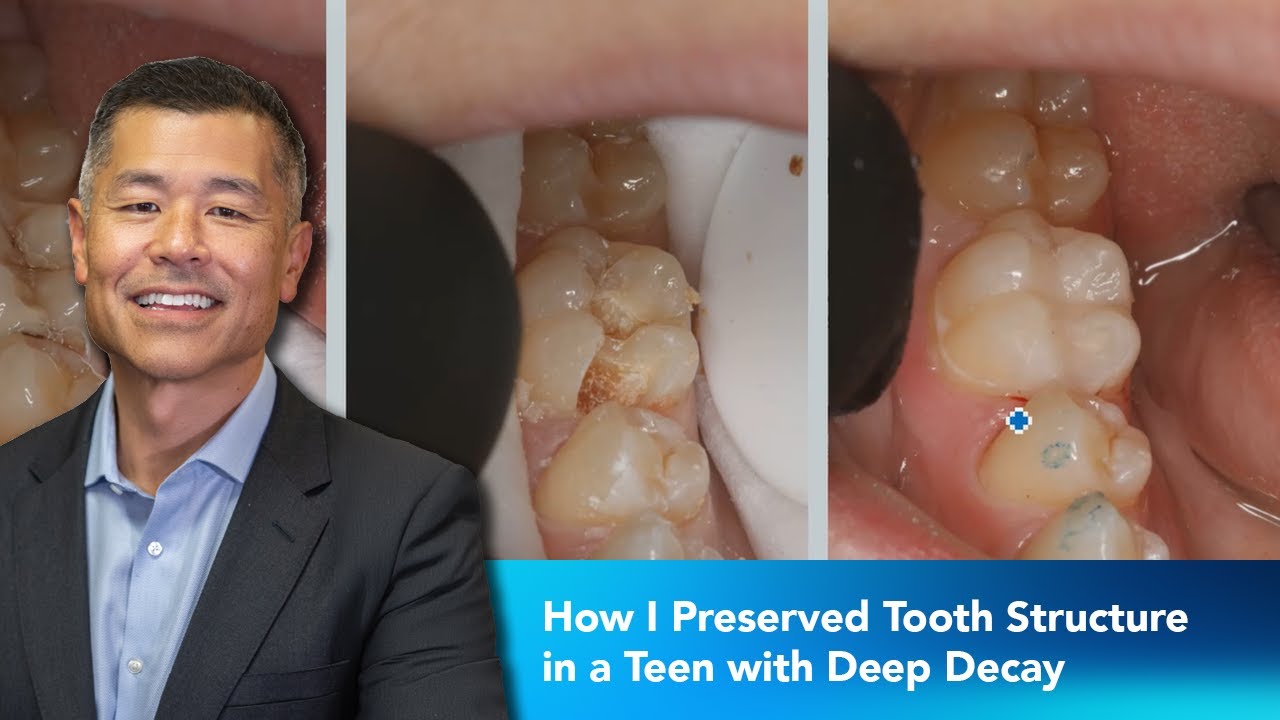 How I Preserved Tooth Structure in a Teen with Deep Decay | Dentist 2 ...