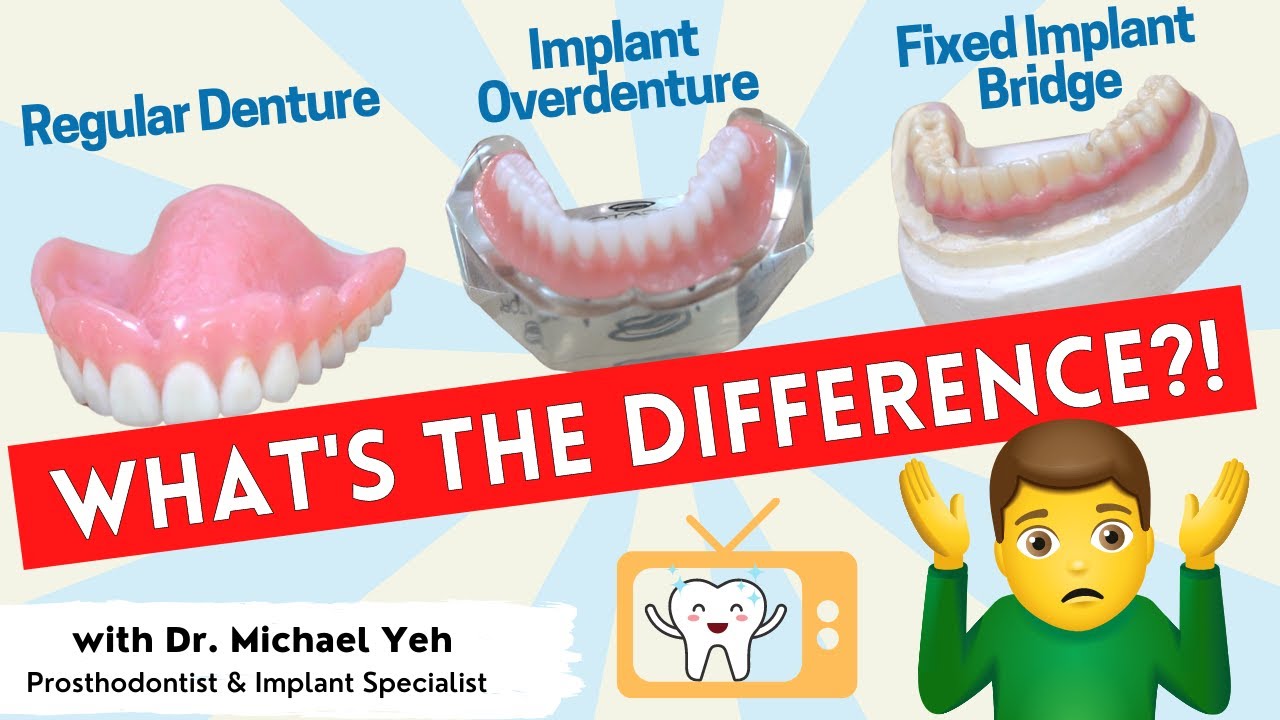 Denture vs. Implant Overdenture vs. Fixed Implant Bridge ...